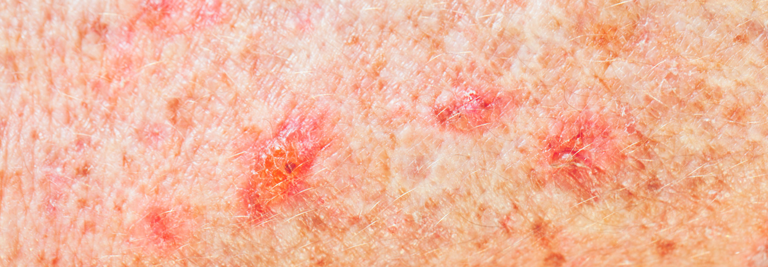 Actinic Keratosis Treatment in South Miami