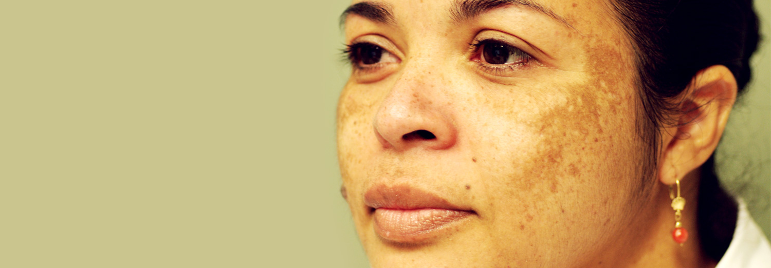 Melasma, South Miami, FL