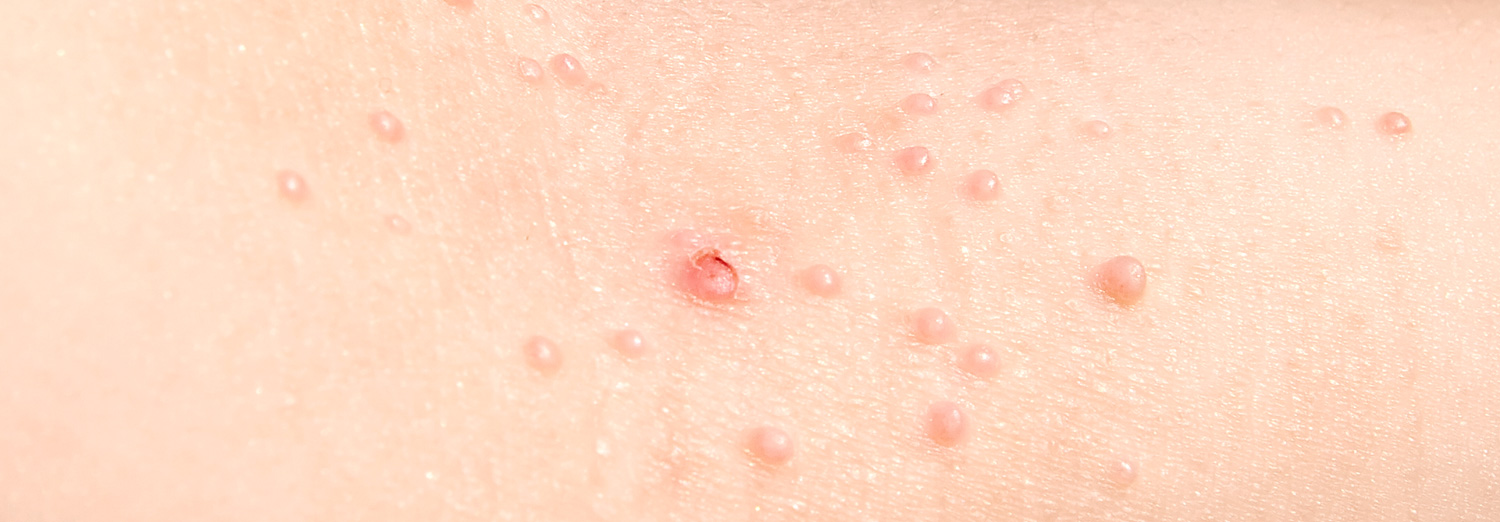 Molluscum Treatments South Miami