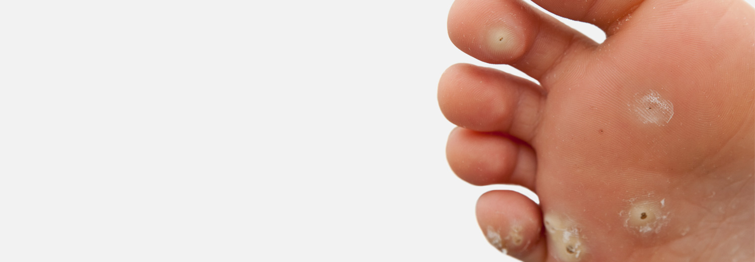 Wart treatments Miami